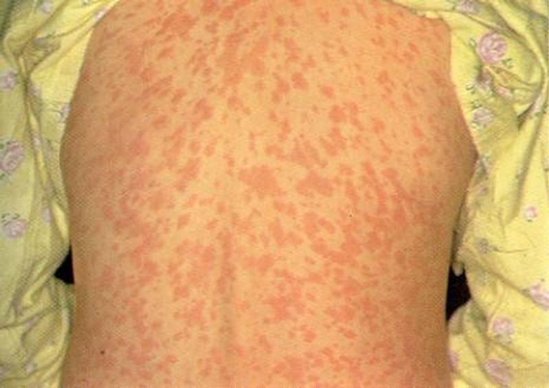 azienda agricola abbattersi Jurassic Park il morbillo porta prurito ...